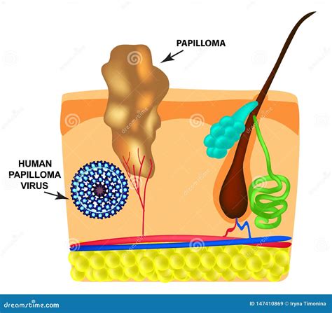 Human Papilloma Virus Causes The Formation Of Papillomas On The Skin