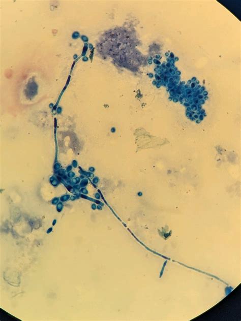Mike Sikatema On Linkedin I Performed A Zn Stain On A Sputum Sample