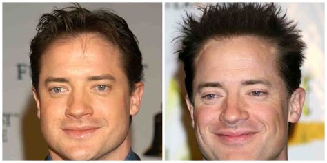 Has Brendan Fraser Had A Hair Transplant Longevita