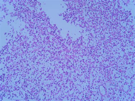 Gemistocytic Astrocytoma Histopathologyguru