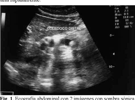 Figure 1 From Residual Lithiasis Versus Primary Lithiasis Bile Duct A
