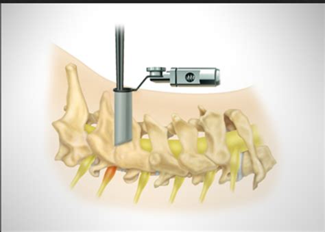 Cervical Micro Discectomy Treatment Service In Nagpur Id 19199366662