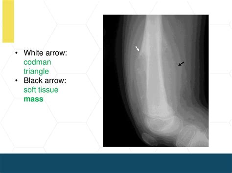 Primary Secondary Metastasis Ppt Download