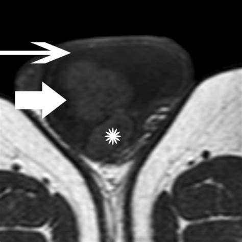 Transverse T1 Weighted Image Depicts A Multilobular Left Scrotal Mass