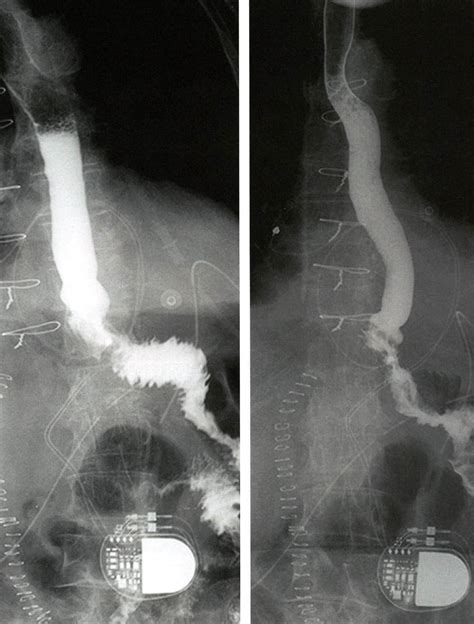 六、吻合器食管空肠端侧吻合术 胃癌手术操作