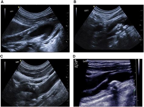 Correlation Between Calcification Characteristics Of Carotid Atherosclerotic Plaque And Plaque