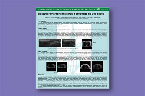 Elastofibroma Dorsi Bilateral A Propósito De Dos Casos Sociedad