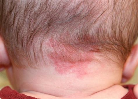 Strawberry Nevus And Other Birthmarks In Pictures Med