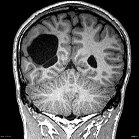 Porencephalic Cyst Pathology