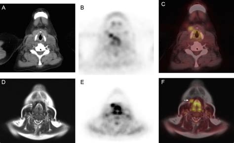 Status Post Thyroidectomy In A Patient With Elevated Thyroxine Binding