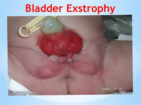 Bladderexstroppptxfewewfefewffffffffef Pptx