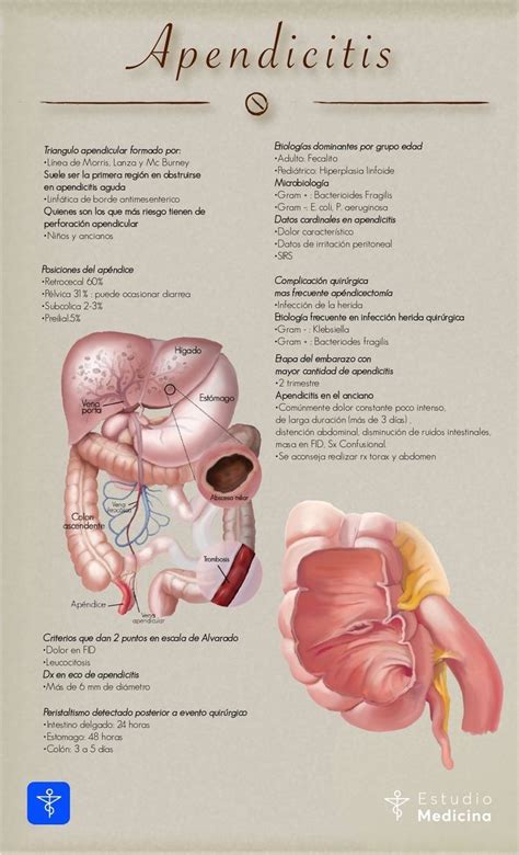 5 Appendicitis Signs You Don T Want To Miss Artofit