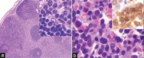 A Lymph Node Biopsy Showing Sinusoidal Infiltration Atypical Download Scientific Diagram