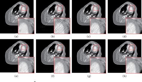 Figure 1 From Robust Low Dose Ct Sinogram Preprocessing Via Exploiting