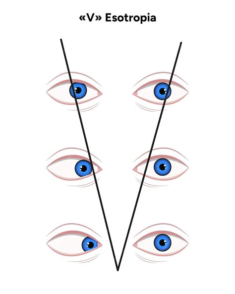 Premium Vector Types Of Strabismus V Esotropia And V Exotropia