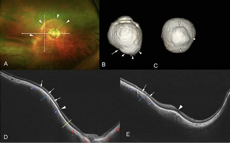 Understanding Posterior Staphyloma In Pathologic Myopia Opth