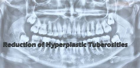 Hegab Academt Reduction Of Hyperplastic Tuberosities
