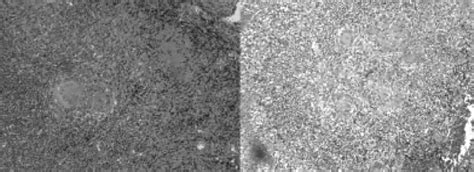 70 Degree Scope Image Showed Complete Resolution Of Supraglottic Mass