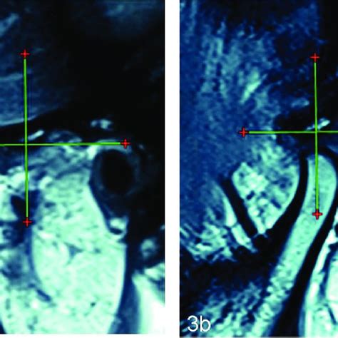 Opg Image Showing Bilateral Dislocation Of The Condyles Download Scientific Diagram