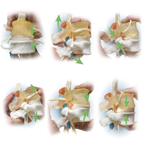 Ai Lumbar Disc Herniation Detection You Only Look Once