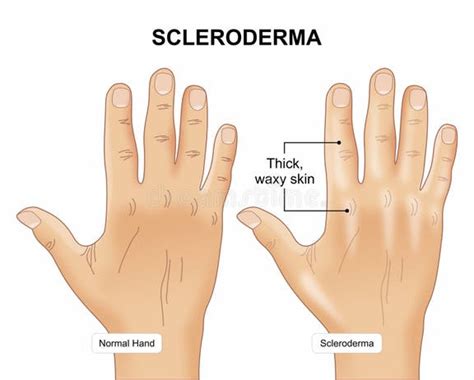 Scleroderma Illustration Stock Image Illustration Of Finger 391892989