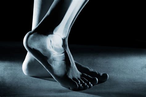 Hairline Fracture Symptoms Treatment And Causes