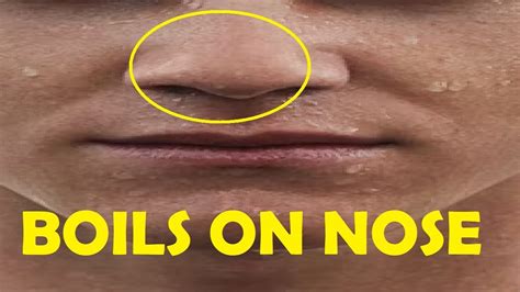 How To Get Rid Of Boils On Your Nose Youtube