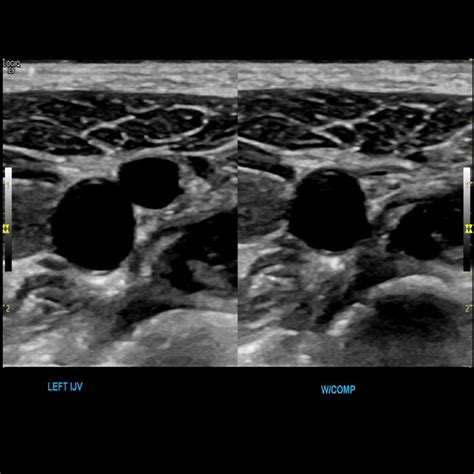 Upper Extremity Venous Doppler Sonographic Tendencies Medical