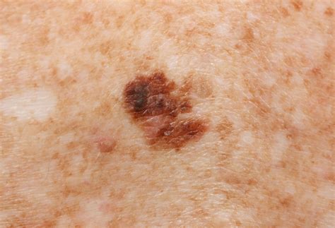 Melanoma Stages Pictures Early Melanome Symptômes Bzln