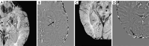 Automatic Detection Of Cerebral Microbleeds Using Susceptibility Weighted Imaging And Artificial
