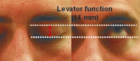 The Neuro Ophthalmic Examination Ento Key