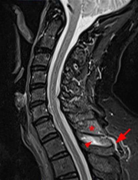 Cervical Interspinous Bursitis Radsource