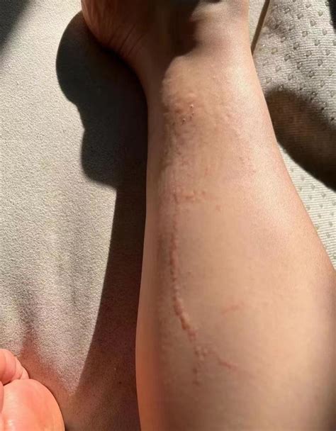 现代西医认为荨麻疹的发病机制是什么 知乎