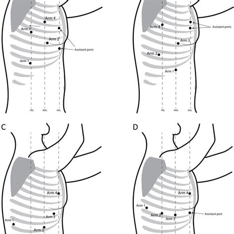 Several Variations For The Thoracic Trocar Placement During The