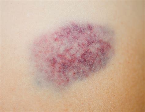 History And Physical Examination In Hematology Classical Hematology