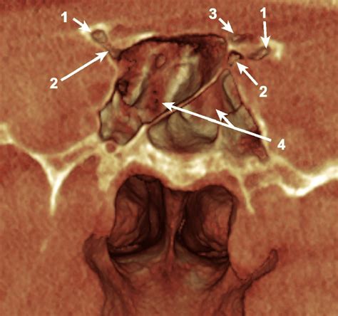 Coronal Bilateral Three Dimensional Volume Rendering Of The Anterior