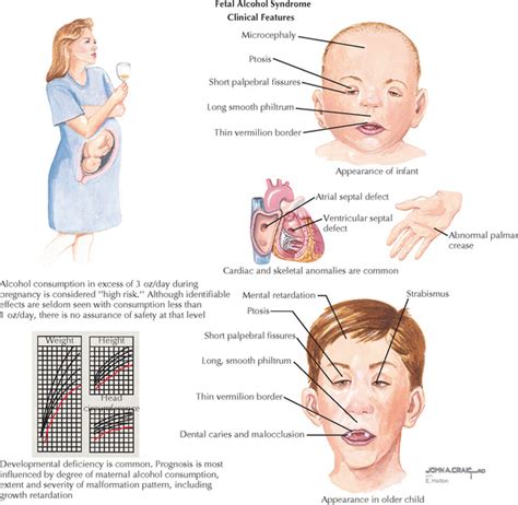 Fetal Alcohol Syndrome Clinical Gateclinical Gate