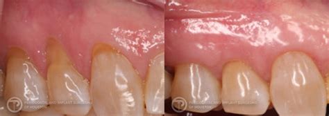 Before And After Alloderm® Gallery Houston Tx