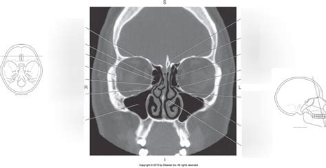 Coronal Ct Of Osteomeatal Unit Diagram Quizlet