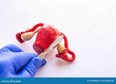 Concept Of Photo Of Ovariectomy Or Oophorectomy Total Or Part Ovaries