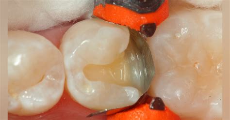 10 Years Of Clinical Success With Composite Resin Technology Case