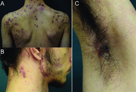 Clinical Presentation Prior To Initiation Of Therapy A Chronic