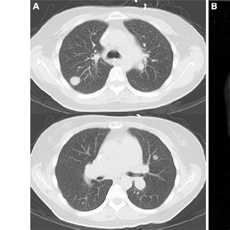 Chest Computed Tomography Showed Bilateral Pulmonary Nodules A And Download Scientific