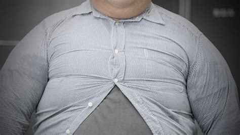 5 Kasus Obesitas Ekstrem Di Dunia Ada Yang Bobotnya Lebih Dari