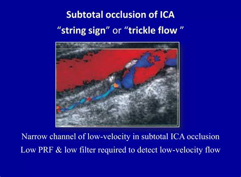 Doppler Ultrasound Of Carotid Arteries Pptx