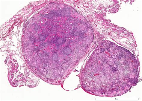 Thyroid Nodule Pathology