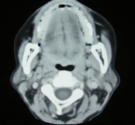 Multiple Sialolithiasis In Sublingual Gland Causing Dysphagia Pmc