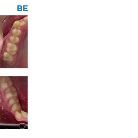 Dentsply Sirona On Linkedin Class Ii With Moderate Crowding High