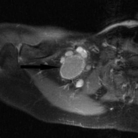 Right Brachial Plexus Mri T1 Weighted Showing The 33cm X 27cm Mass Download Scientific Diagram