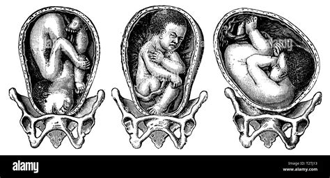 Transverse Presentation